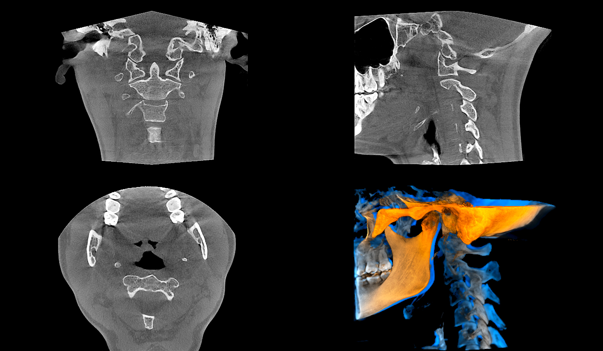 Perspektive DVT – Einsatz der digitalen Volumentomographie in der HWS ...