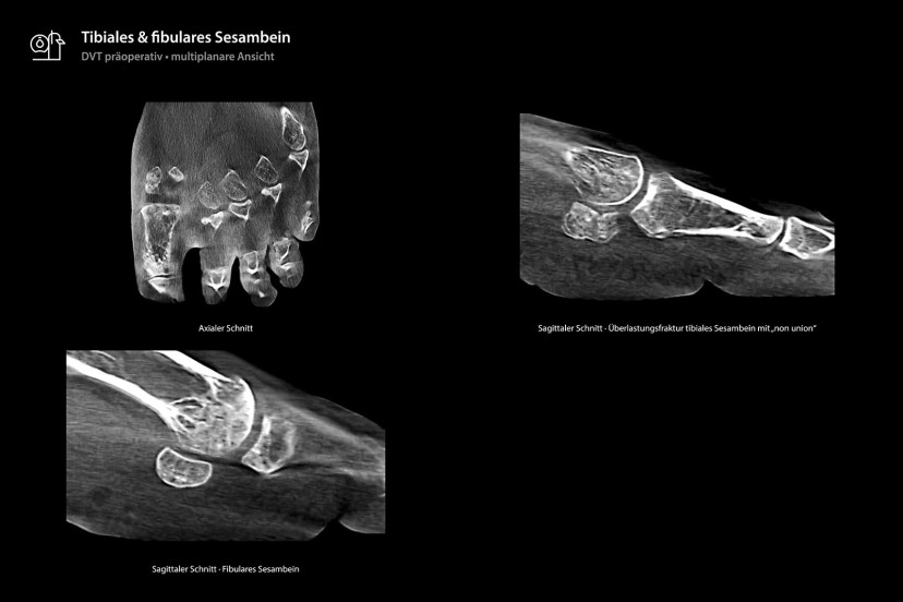 Perspektive DVT – „Chirurgische Behandlung einer Sesambein ...