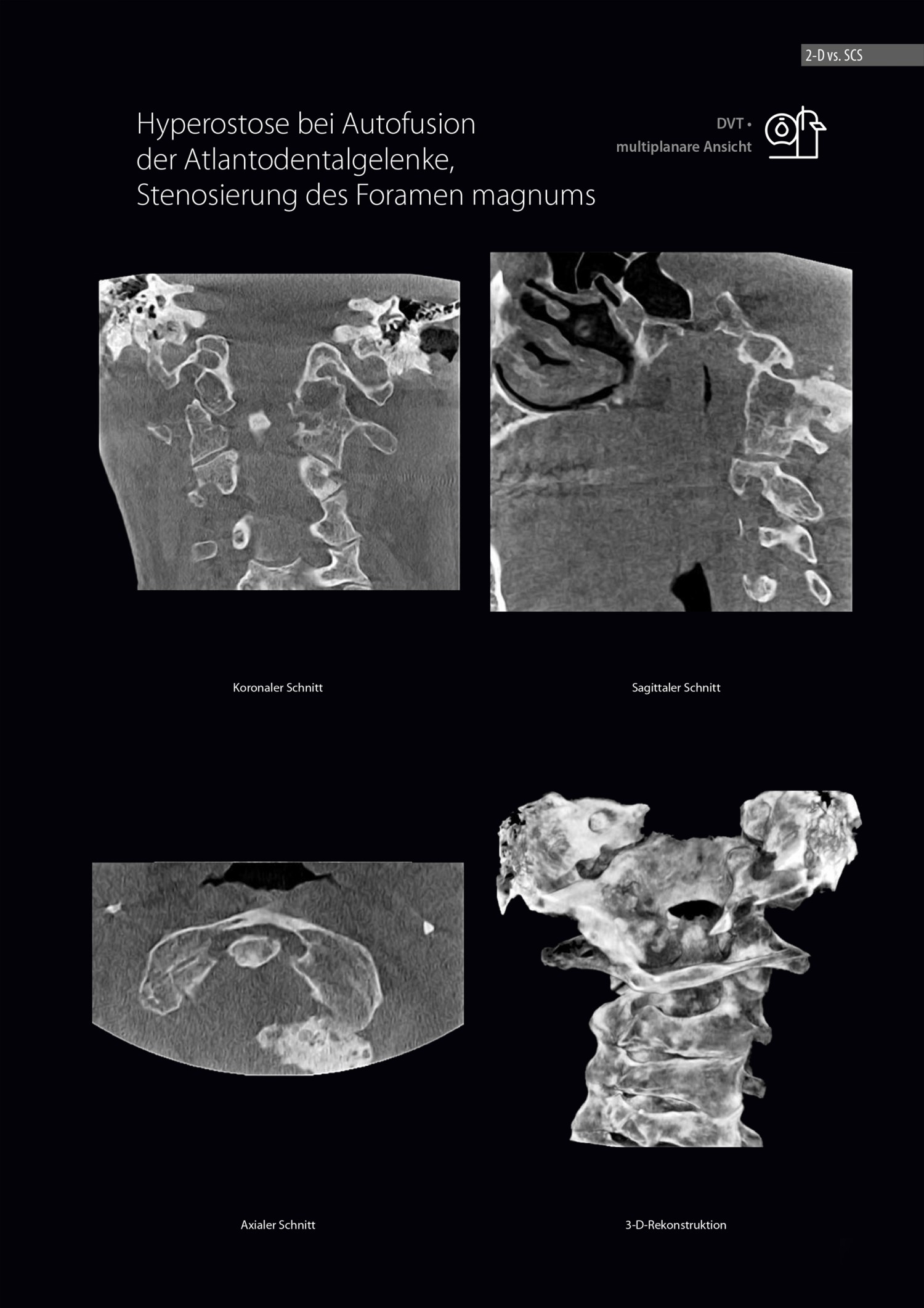 Die SCS Bildgebung in der HWS-Diagnostik – BVOU Netzwerk