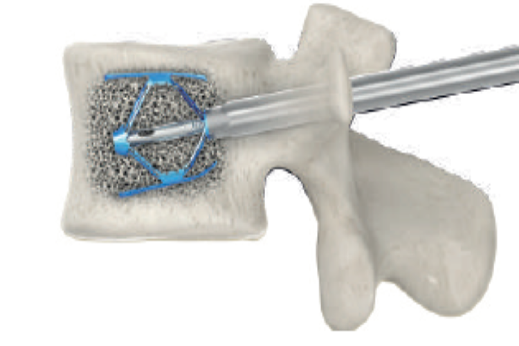 SpineJack 750x500 – BVOU Netzwerk