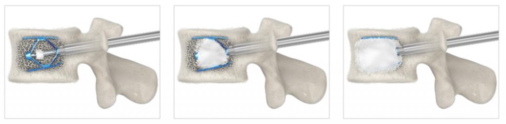 Better Care starts with knowing the facts – SpineJack System – BVOU ...