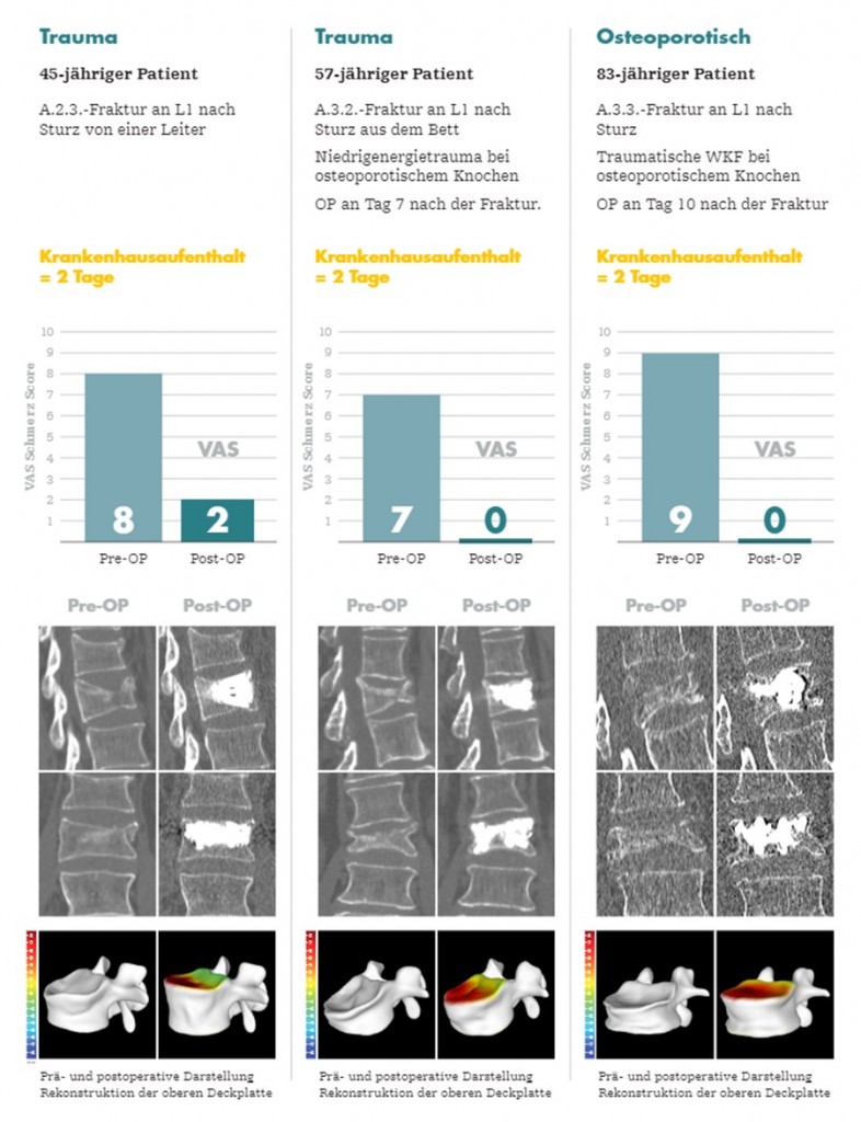 Better Care starts with knowing the facts – SpineJack System – BVOU ...