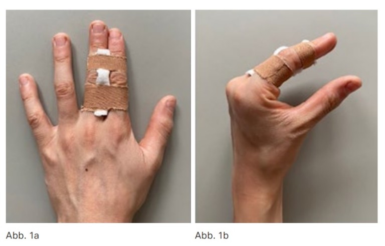 Wiederherstellung der Funktion bei Fingerfrakturen – BVOU Netzwerk